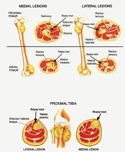 Bone-Forming Bone Tumors and Tumor-like Lesions | Basicmedical Key