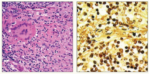Cat Scratch Disease | Basicmedical Key