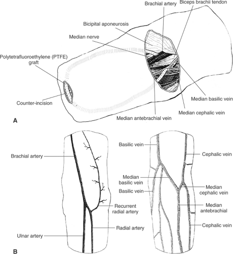 Vascular Access for Hemodialysis | Basicmedical Key