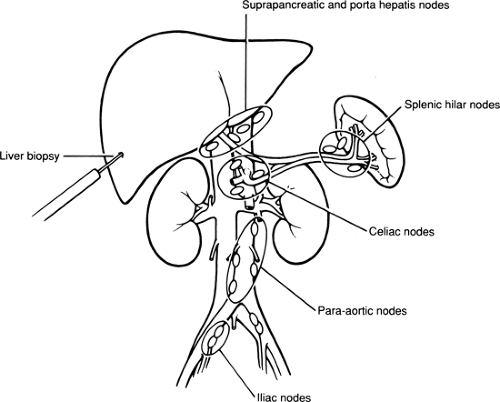 Splenectomy and Splenorrhaphy | Basicmedical Key