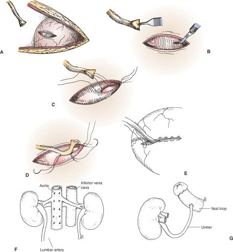 Cadaveric Donor Nephrectomy and Renal Transplantation | Basicmedical Key