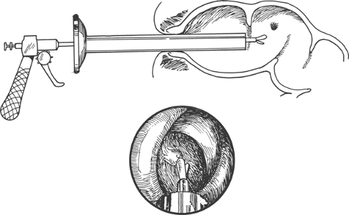 Sigmoidoscopy | Basicmedical Key