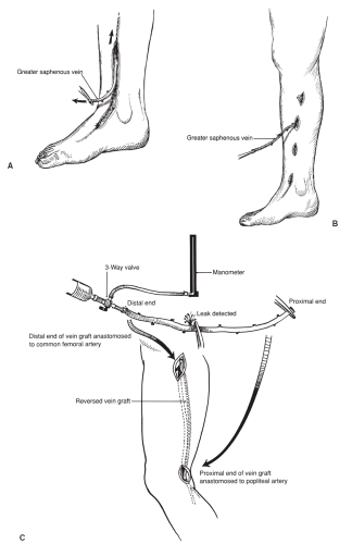 Ligation, Stripping, and Harvesting of the Saphenous Vein ...