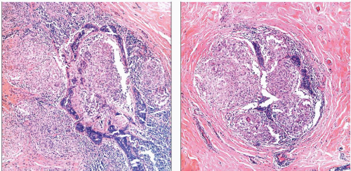Lactational Abscess | Basicmedical Key
