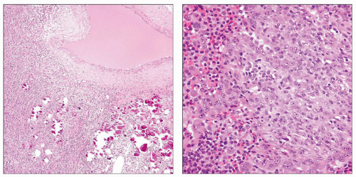 Leiomyosarcoma | Basicmedical Key