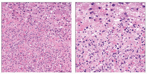 Pyogenic Abscess | Basicmedical Key