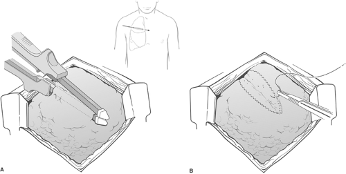 Thoracic Trauma | Basicmedical Key