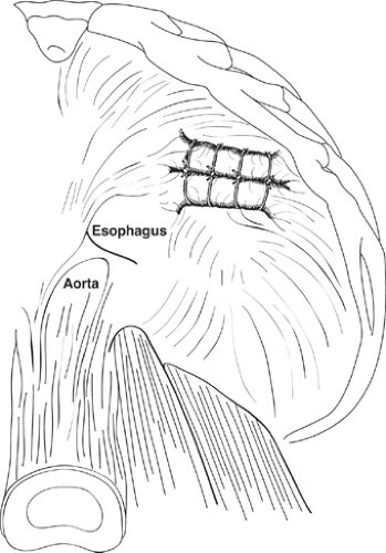 The Anatomy of the Esophagus | Basicmedical Key