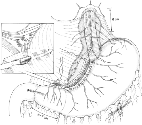 Bleeding Duodenal Ulcer | Basicmedical Key