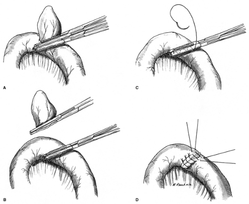 Adjunctive Procedures in Intestinal Surgery | Basicmedical Key