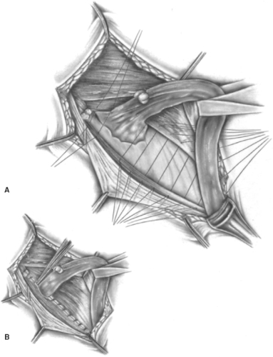 Iliopubic Tract Repair of Inguinal Hernia: the Anterior (Inguinal Canal ...