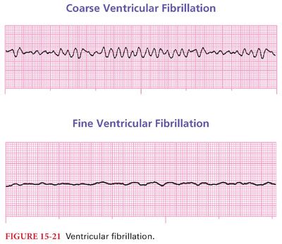 Fine Ventricular Fibrillation Vs Coarse Ventricular Fibrillation