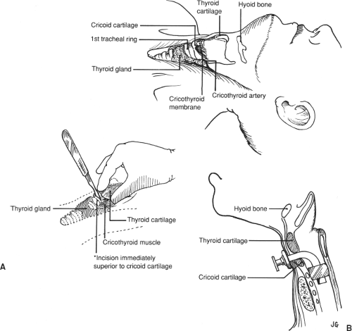 Cricothyroid Membrane Incision