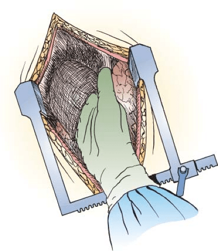Tube Thoracostomy, Thoracotomy, Partial Pulmonary (Wedge) Resection ...