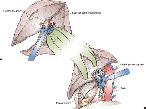 Lobectomy | Basicmedical Key