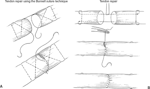 Tendon Repair | Basicmedical Key
