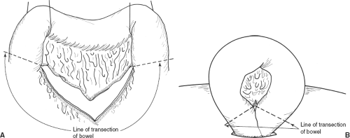 Loop Colostomy and Colostomy Closure | Basicmedical Key