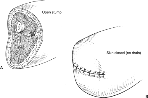 Transmetatarsal and Ray Amputations | Basicmedical Key