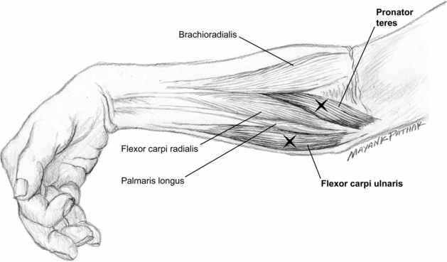 The use of botulinum neurotoxin in tic disorders and essential hand and ...