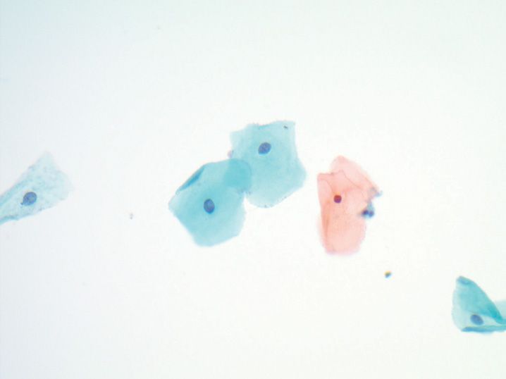 Cytology: Gynecologic | Basicmedical Key
