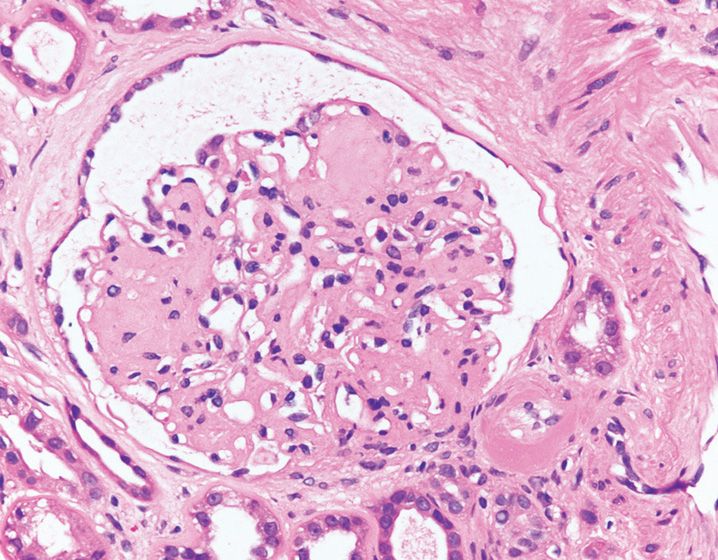 Medical Renal Pathology | Basicmedical Key