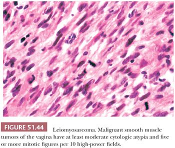 Vulva and Vagina | Basicmedical Key