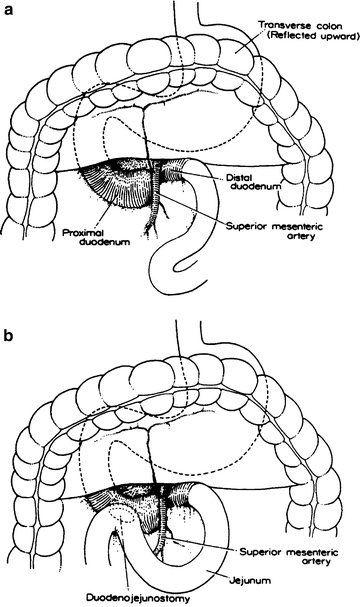 Duodenum | Basicmedical Key