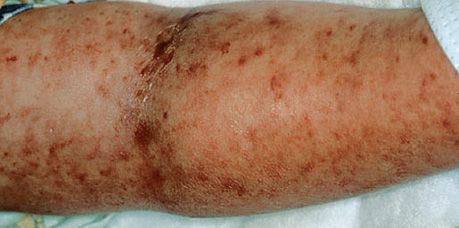 Rickettsiae | Basicmedical Key