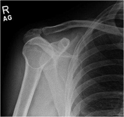 Shoulder x-ray | Basicmedical Key