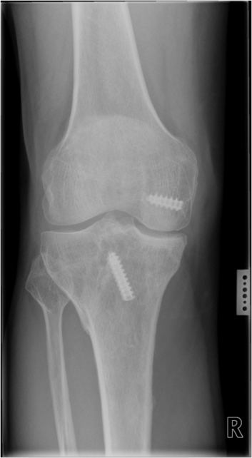 Knee x-ray | Basicmedical Key