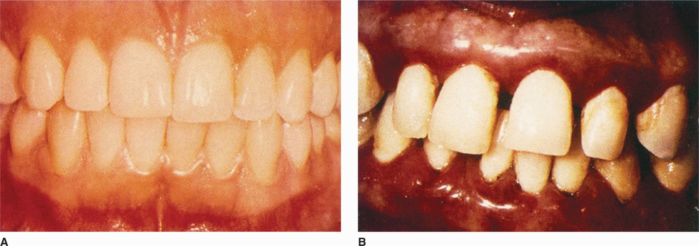 41 Dental and Periodontal Infections | Basicmedical Key