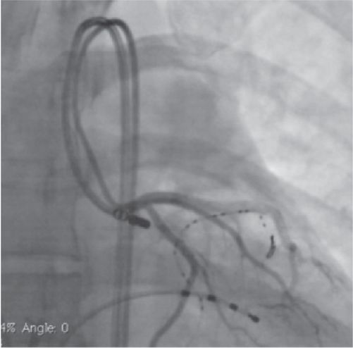 Diagnostic Maneuvers for Supraventricular Tachycardia: PVC on His and ...
