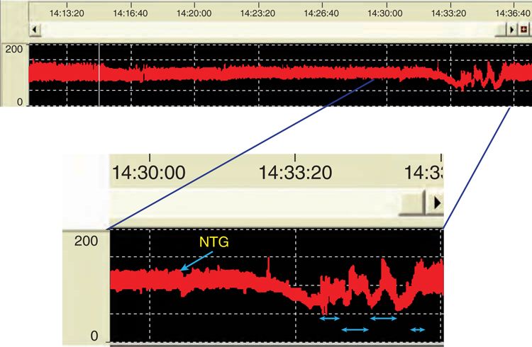 Vasodepressor Syncope | Basicmedical Key