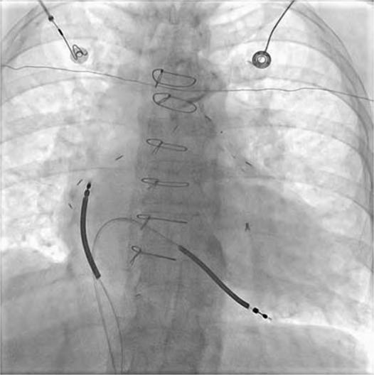 Magnetic Resonance Imaging and Cardiac Implantable Electronic Devices ...