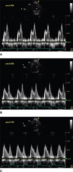 Cardiac Resynchronization Therapy | Basicmedical Key