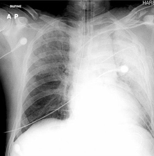Thoracic Trauma | Basicmedical Key