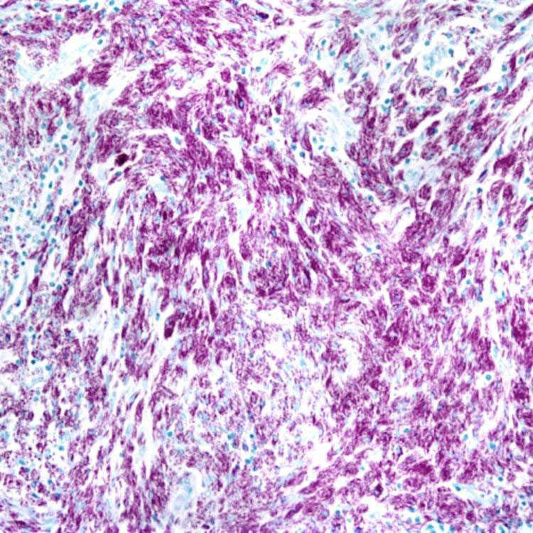 Atypical Mycobacteria | Basicmedical Key