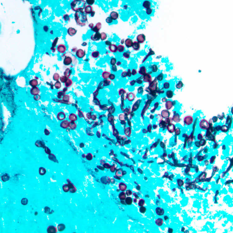 Candidiasis | Basicmedical Key