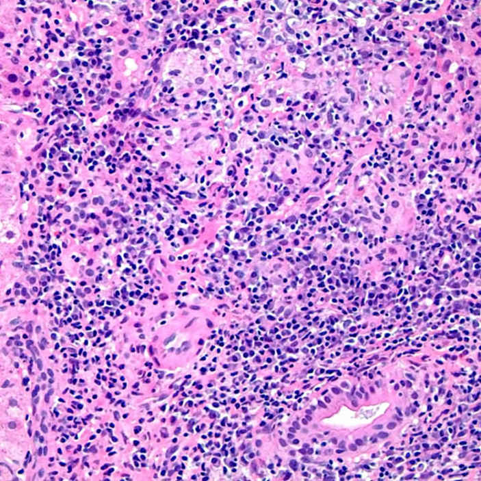 Primary Biliary Cholangitis | Basicmedical Key