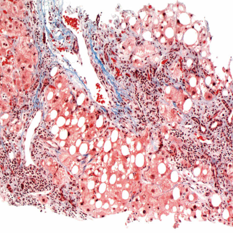 Drug-Related Steatohepatitis/Phospholipidosis | Basicmedical Key