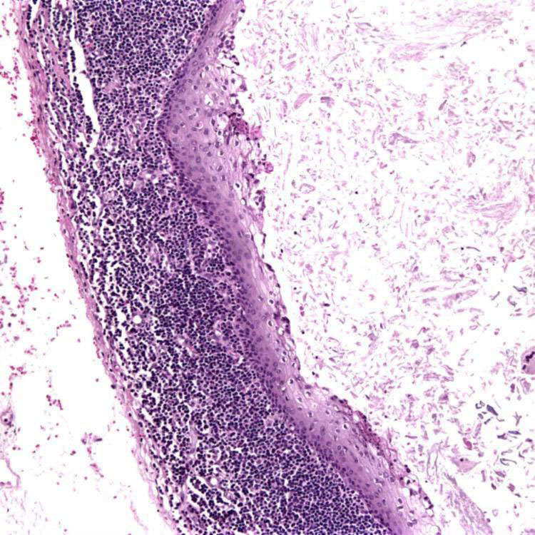 Lymphoepithelial Cysts | Basicmedical Key