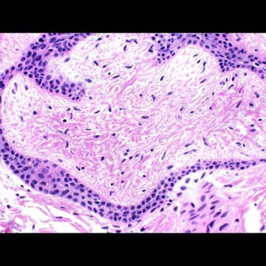 Fibrofolliculoma and Trichodiscoma | Basicmedical Key