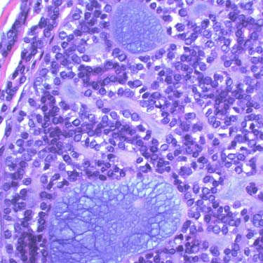 Primary Cutaneous Mucinous Carcinoma | Basicmedical Key