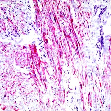 Digital Fibromatosis (Infantile Digital Fibromatosis) | Basicmedical Key