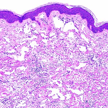 Lymphangioma and Superficial Lymphangioma | Basicmedical Key
