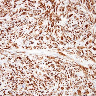 Leiomyosarcoma | Basicmedical Key