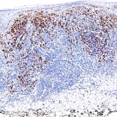 Halo Nevi | Basicmedical Key