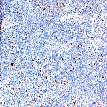 Nevoid Melanoma | Basicmedical Key