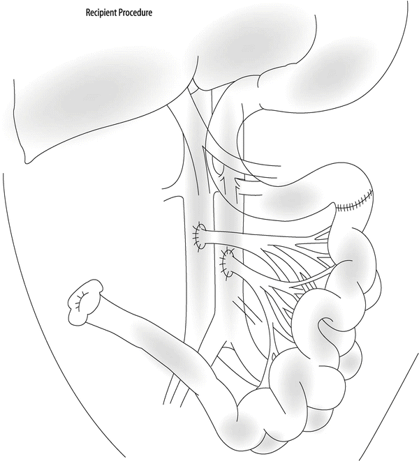 Intestinal and Multivisceral Transplantation | Basicmedical Key
