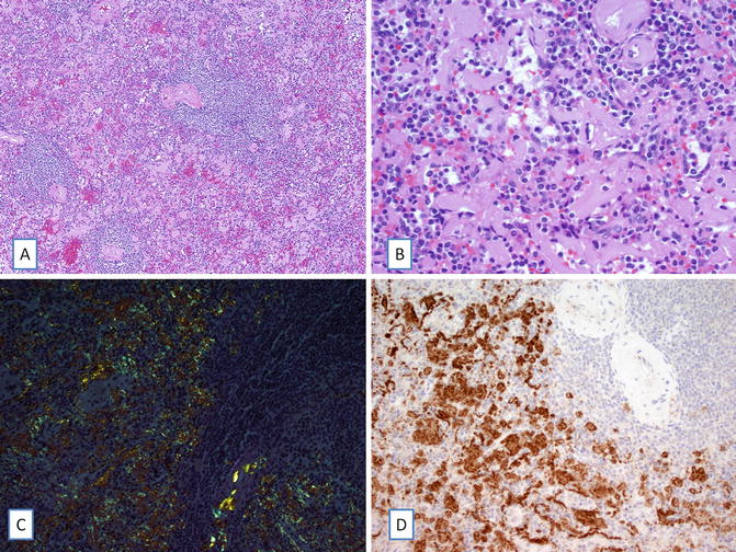 Amyloidosis of the Lymph Nodes and the Spleen | Basicmedical Key